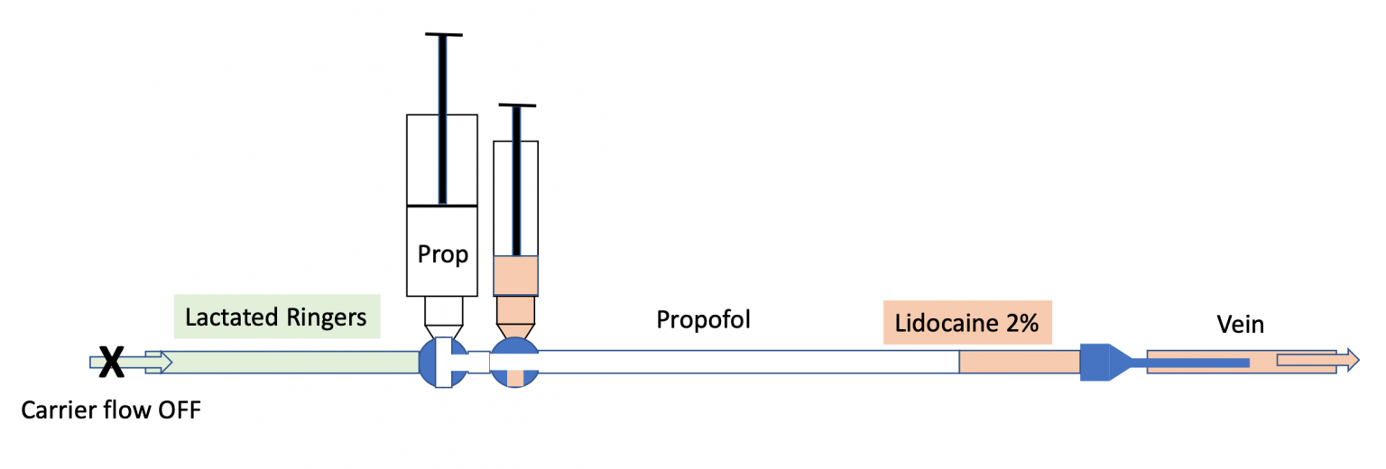 Pain on Propofol Injection – Depth of Anesthesia