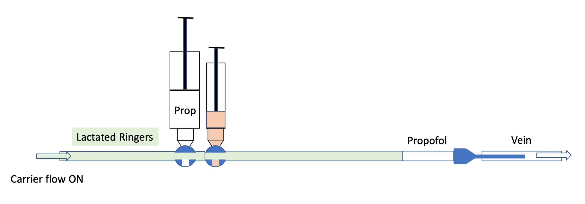Pain on Propofol Injection – Depth of Anesthesia